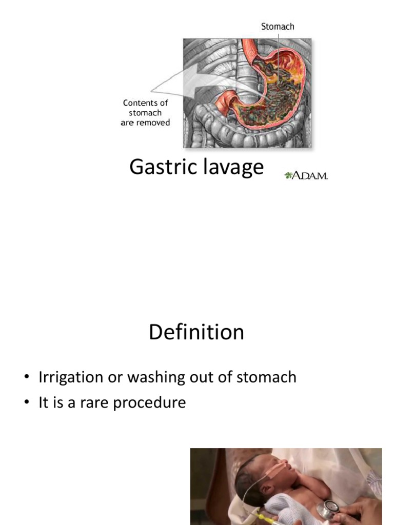 Gastric Lavage | PDF | Medical Specialties | Clinical Medicine