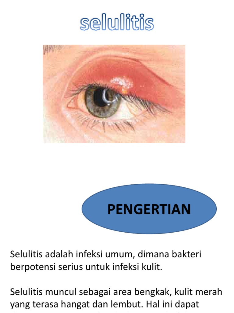 Selulitis | PDF | Sains & Matematika