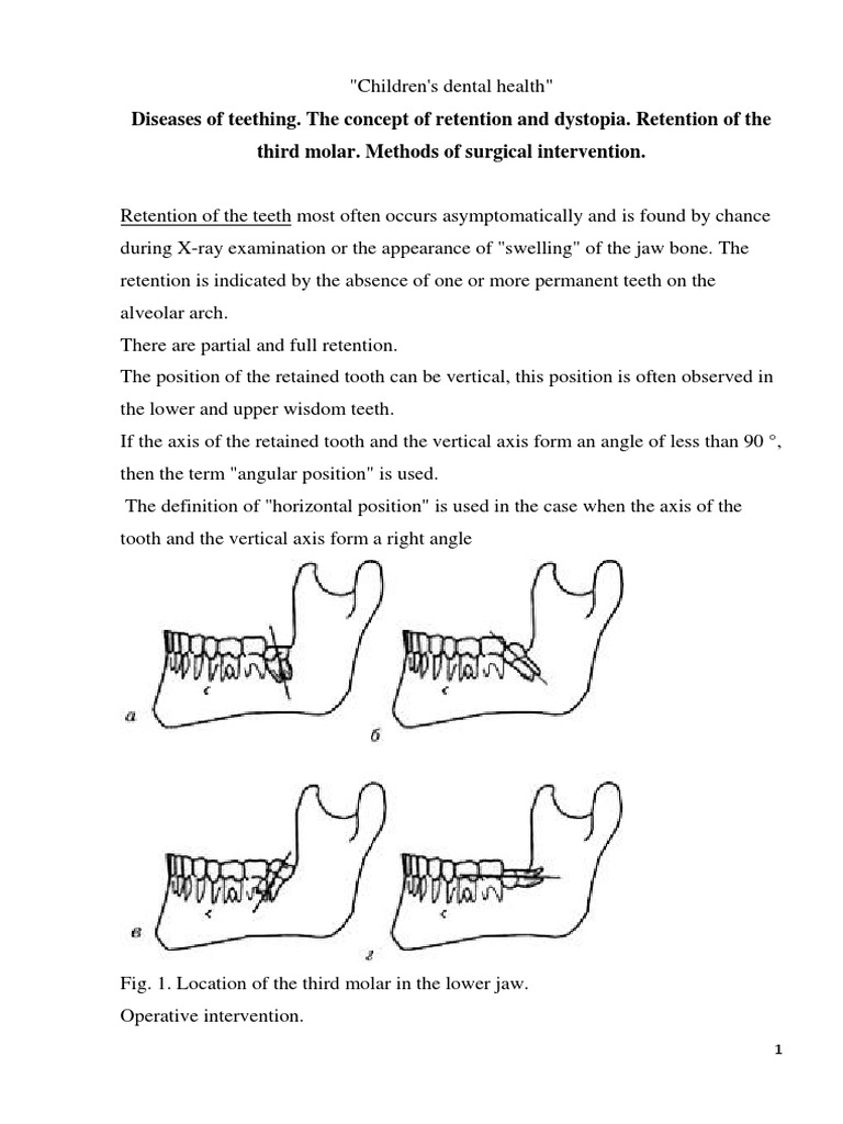 Retention and Extraction of Third Molars | PDF | Tooth | Mouth