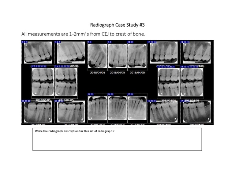 Radiograph Case Study #3 All Measurements Are 1-2mm's From CEJ To Crest ...