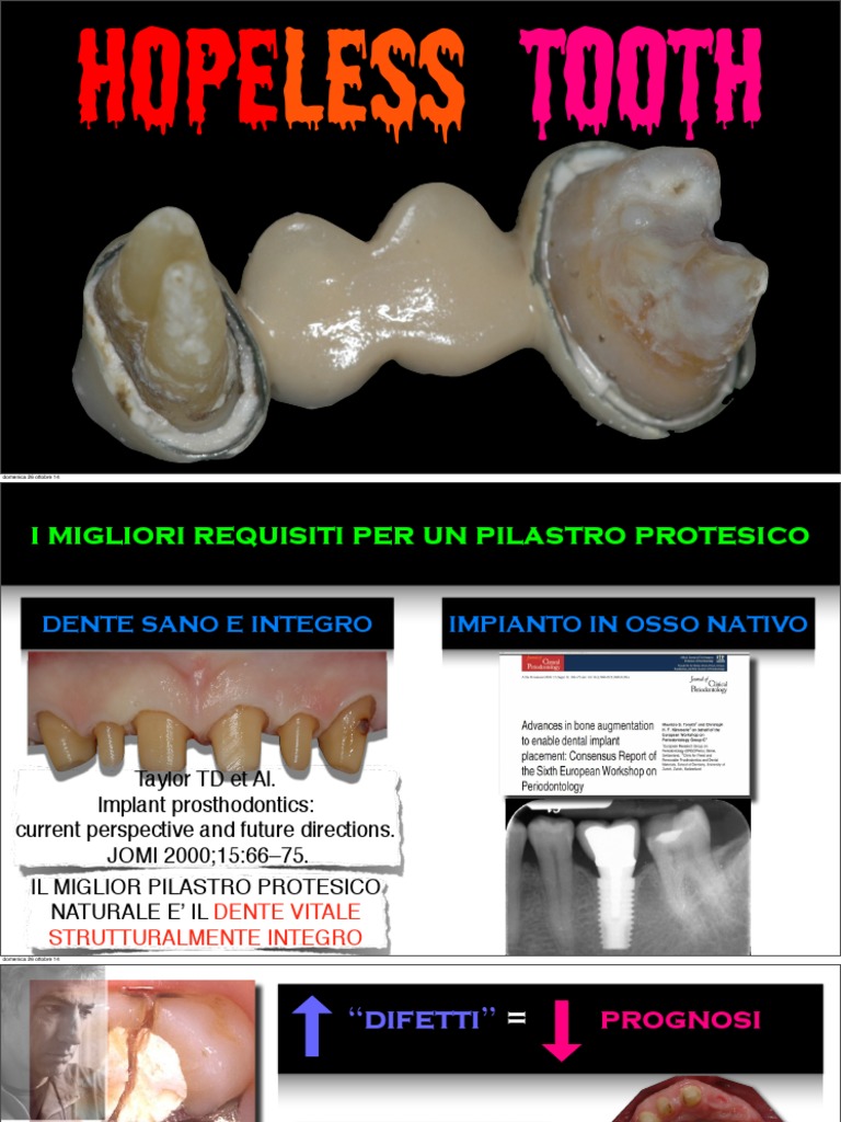 Estratto Hopeless Tooth | PDF | Dental Implant | Facial Features