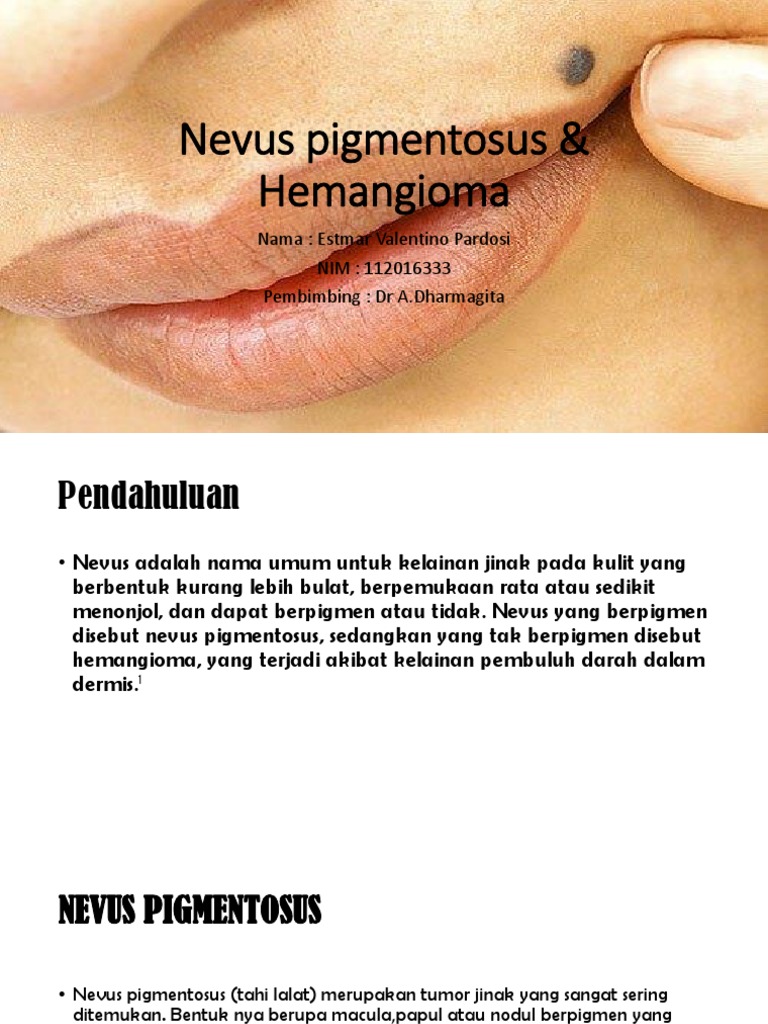 Nevus Pigmentosus & Hemangioma | PDF