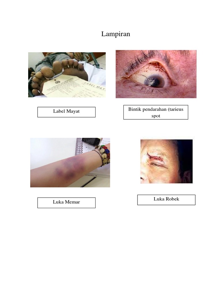Lampiran: Label Mayat Bintik Pendarahan (Tarieus Spot | PDF