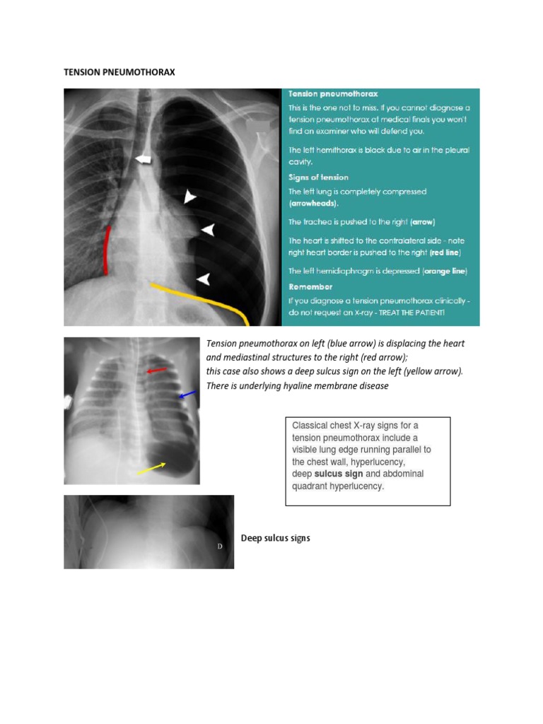 Tension Pneumothorax Overview and Management | PDF | Lung | Thorax