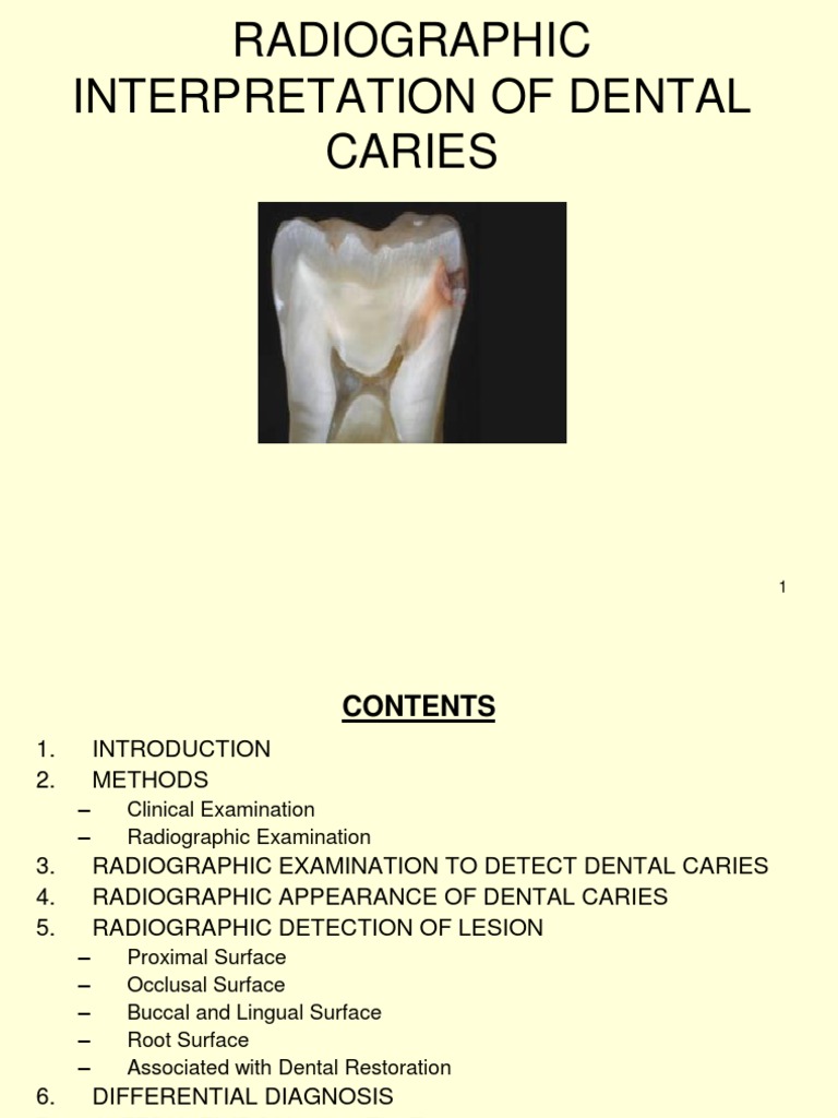 Radiographic Interpretation of Dental Caries - Dental eBook & Lecture ...