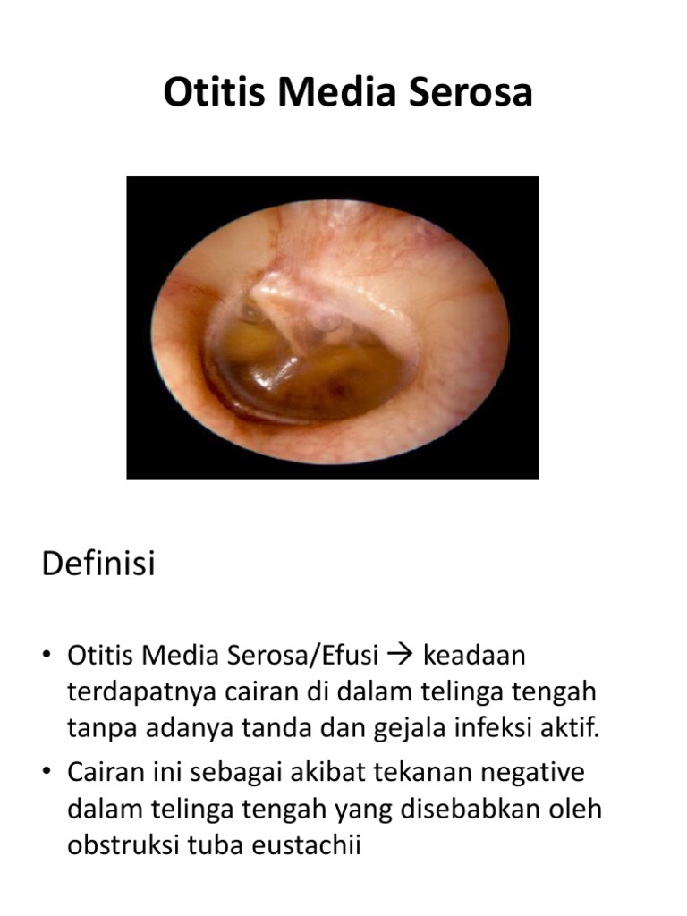 Otitis Media Serosa | PDF