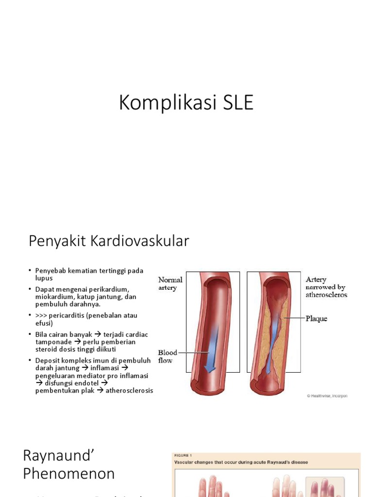 Komplikasi Sle | PDF