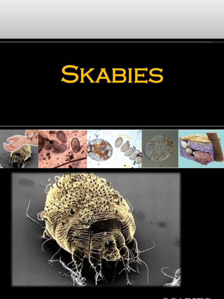 Materi Scabies | PDF