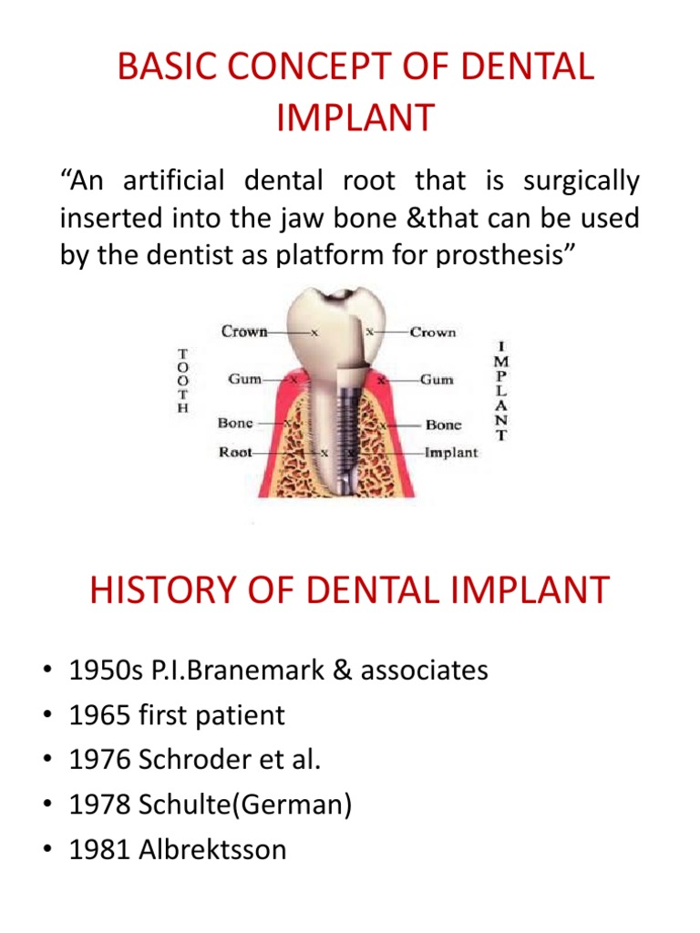 Basic Concept Dental Implant | PDF | Dental Implant | Epithelium