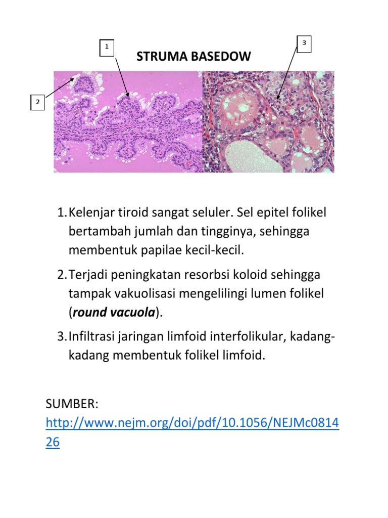 Struma Basedow | PDF