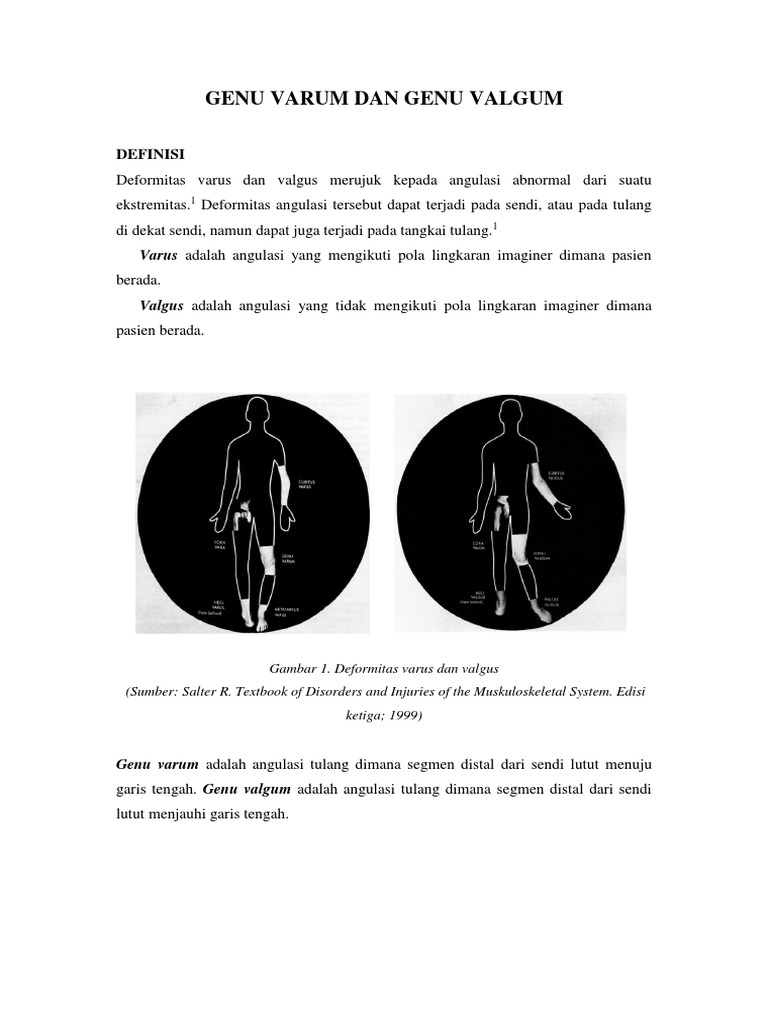 Genu Varum dan Valgum: Definisi dan Etiologi | PDF | Pengembangan Diri ...