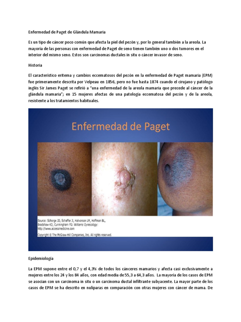 Enfermedad de Paget en el Pezón | PDF | Biopsia | Pecho