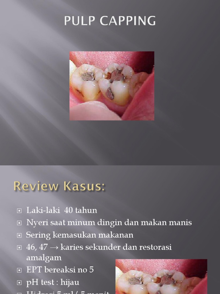 Pulp Capping | PDF