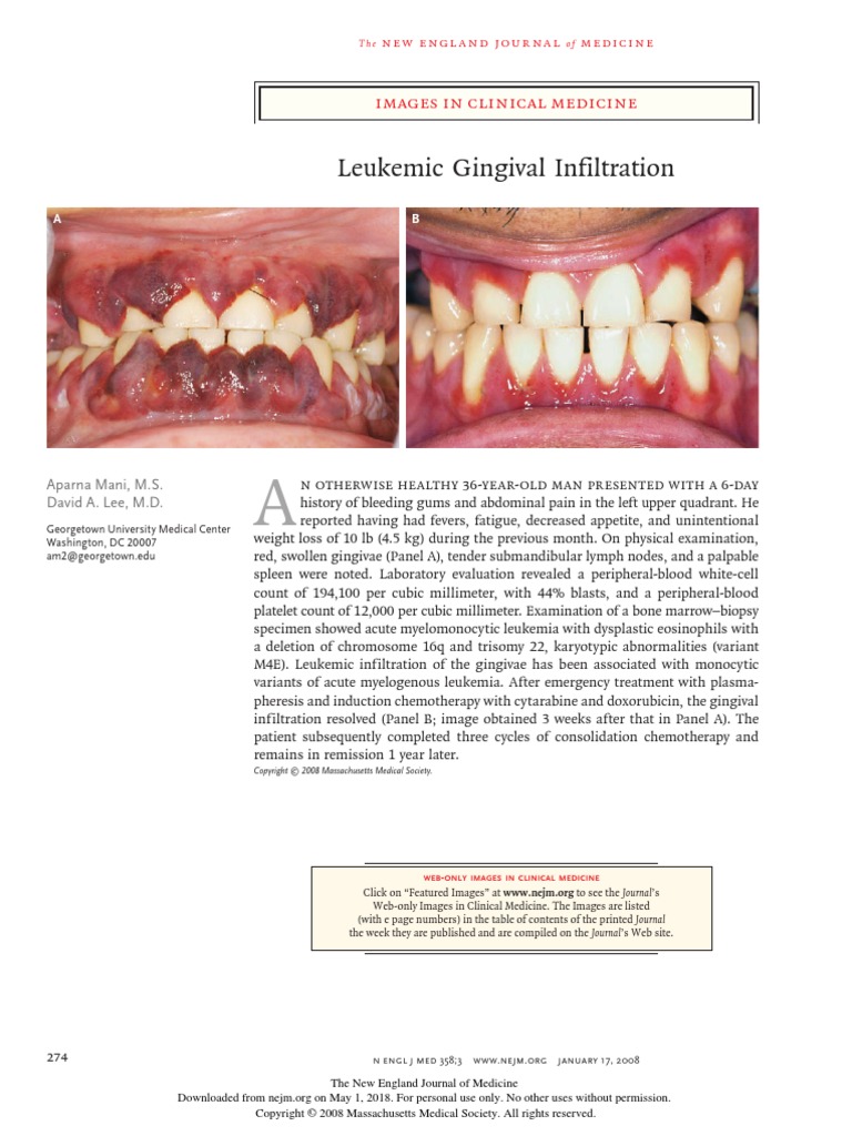 Leukemic Gingival Infiltration | PDF | Leukemia | Clinical Medicine