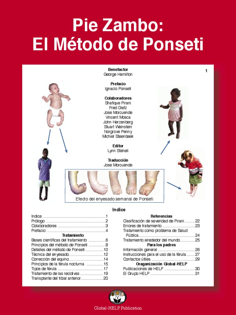 Pie Zambo El Método Ponseti | PDF | Pie | Sistema musculoesquelético