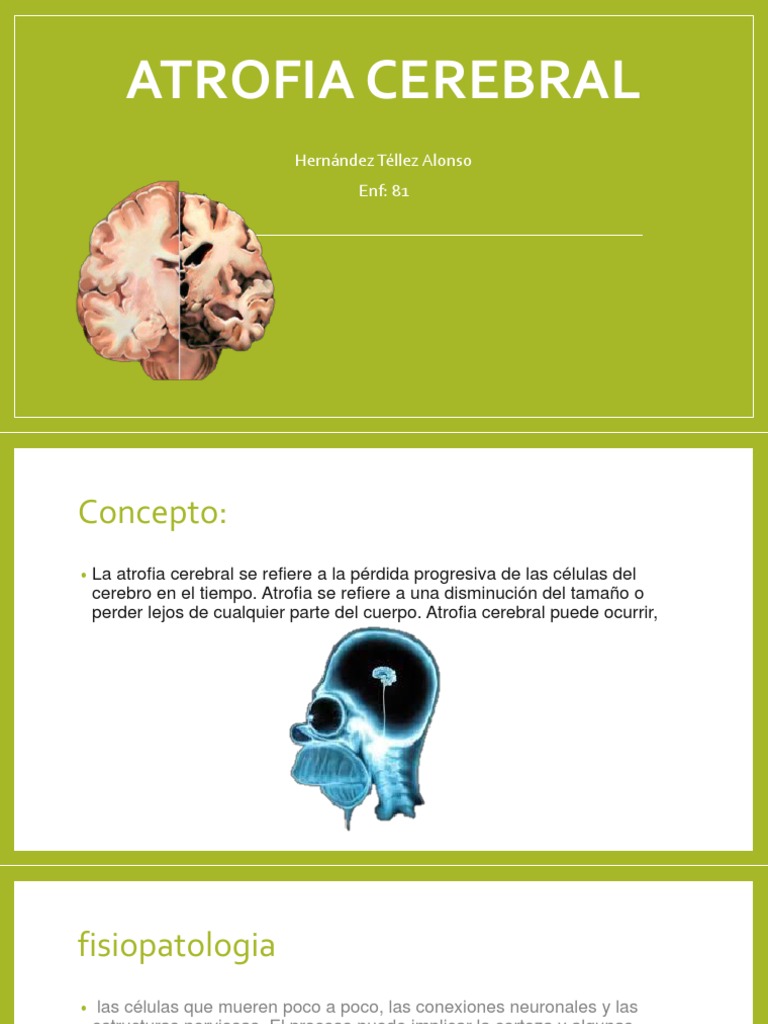 Atrofia Cerebral | Enfermedad de Alzheimer | Cerebro