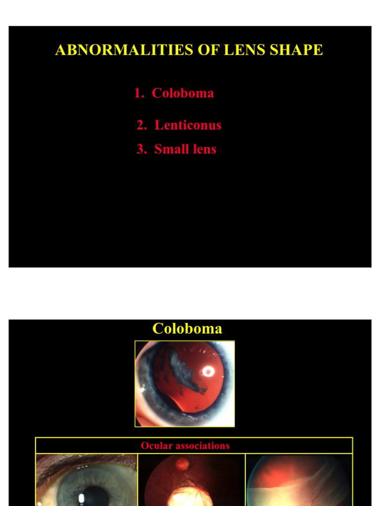 Abnormal Lens Shape | PDF
