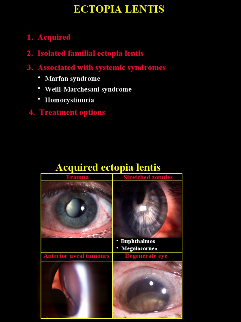 Ectopia Lentis Types & Treatments | PDF | Science & Mathematics