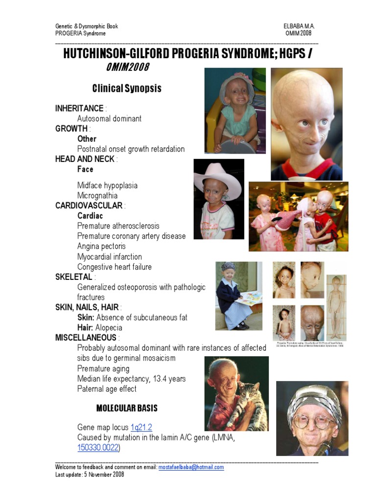 A Clinical Synopsis of Hutchinson-Gilford Progeria Syndrome | PDF