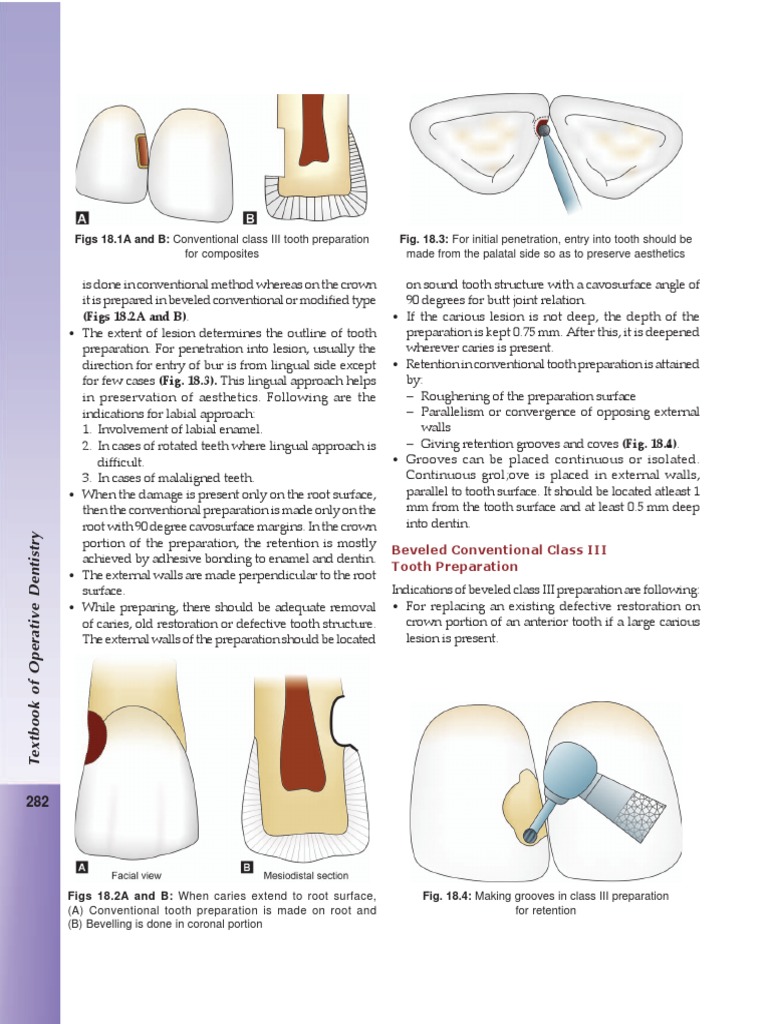 Class I V | PDF | Dental Composite | Tooth Enamel