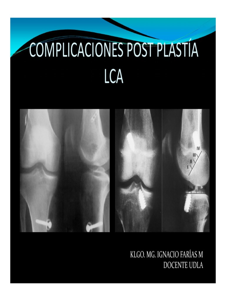Complicaciones Post Plastia Lca | PDF | Rodilla | Anatomía del miembro ...