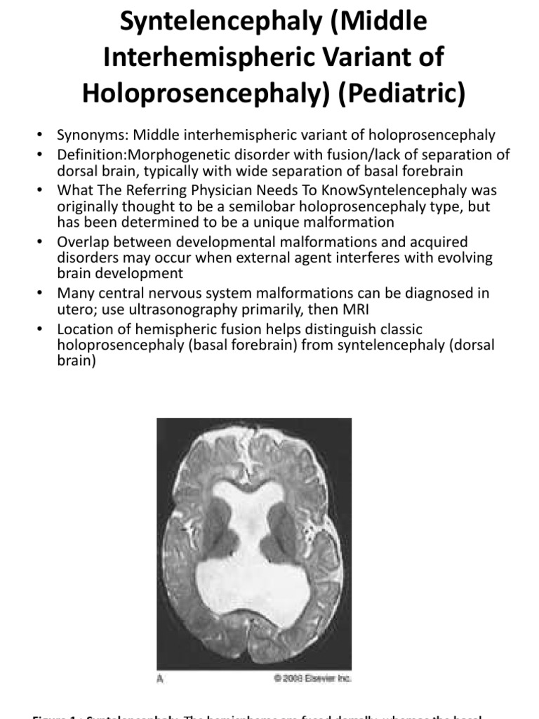 Syntelencephaly (Middle Interhemispheric Variant of Holoprosencephaly ...