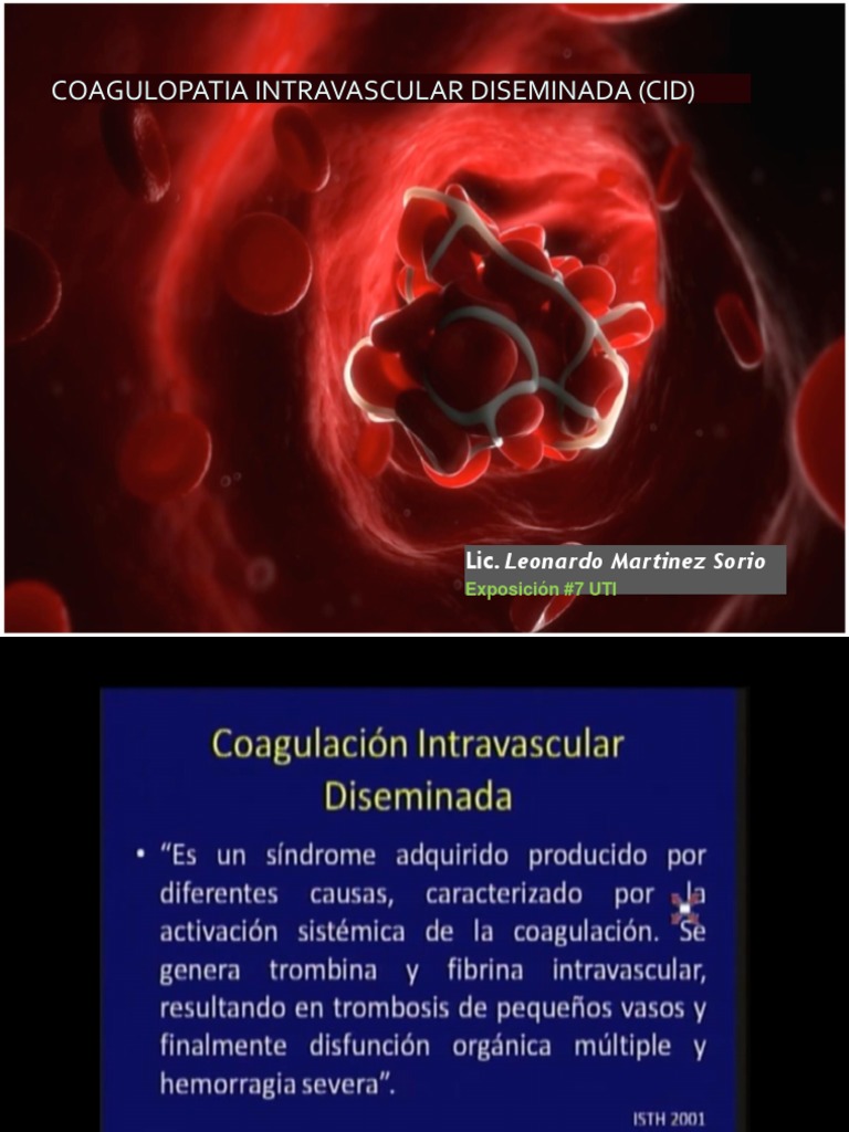 Cid Coagulacion Intravascular Diseminada | PDF