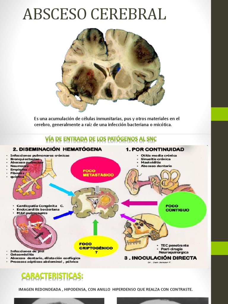 Síntomas y etapas del absceso cerebral | PDF | Neurología | Epidemiología