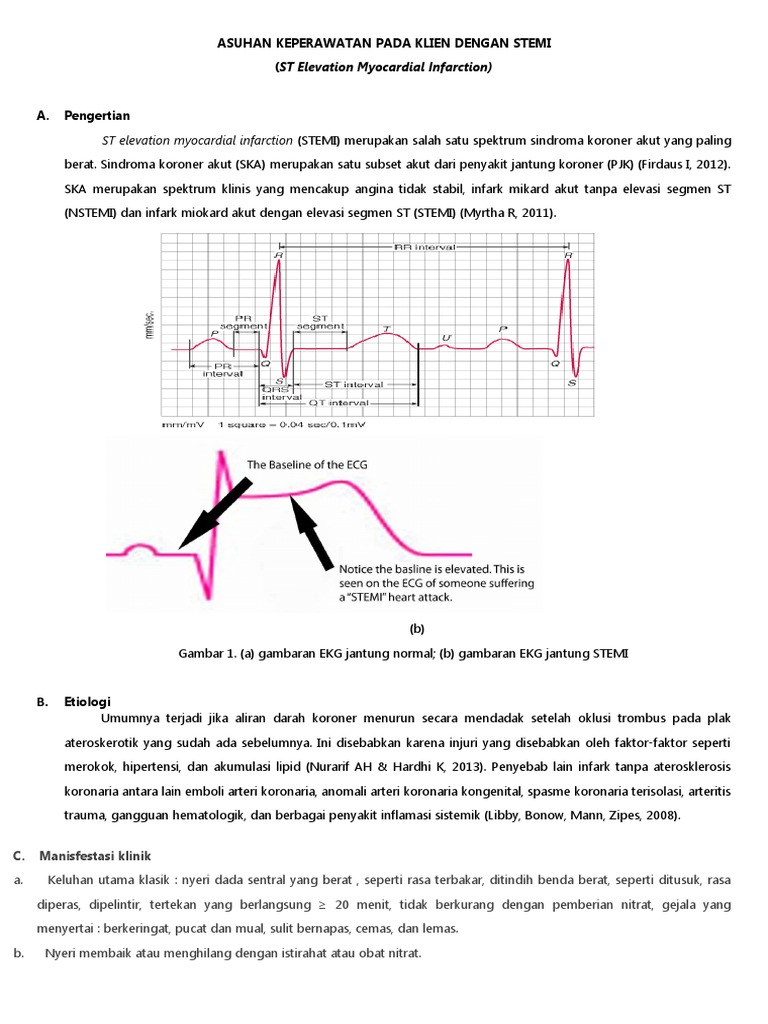 LP STEMI | PDF