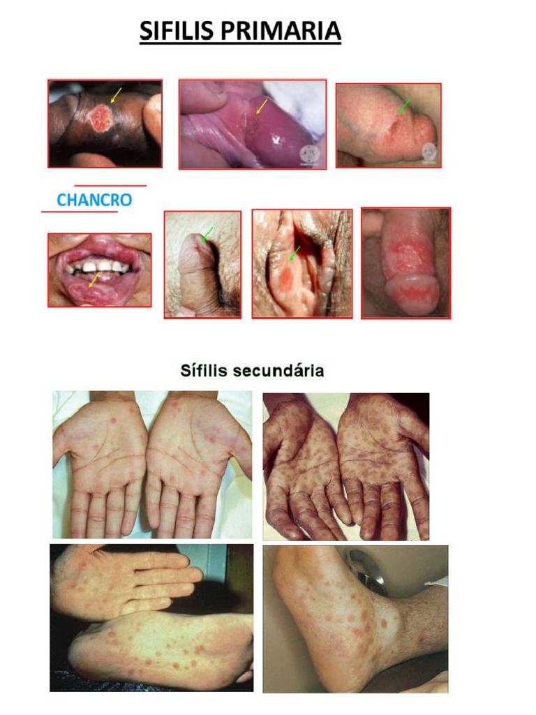 Sifilis | PDF