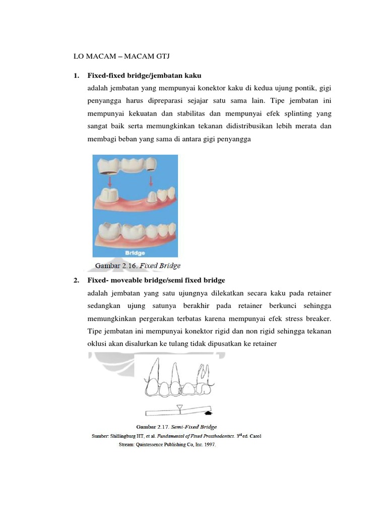 JENIS-JENIS GIGI TIRUAN JEMBATAN DAN PENERAPANNYA | PDF