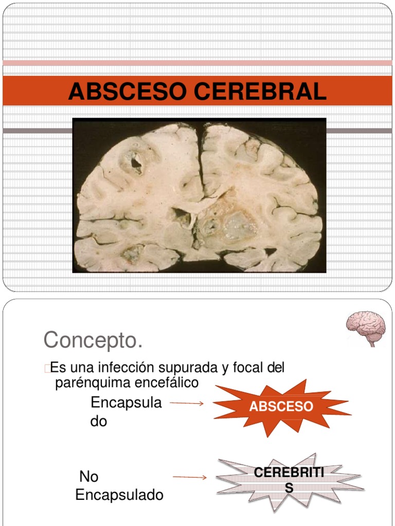 Absceso Cerebral | Especialidades Medicas | Enfermedades y trastornos