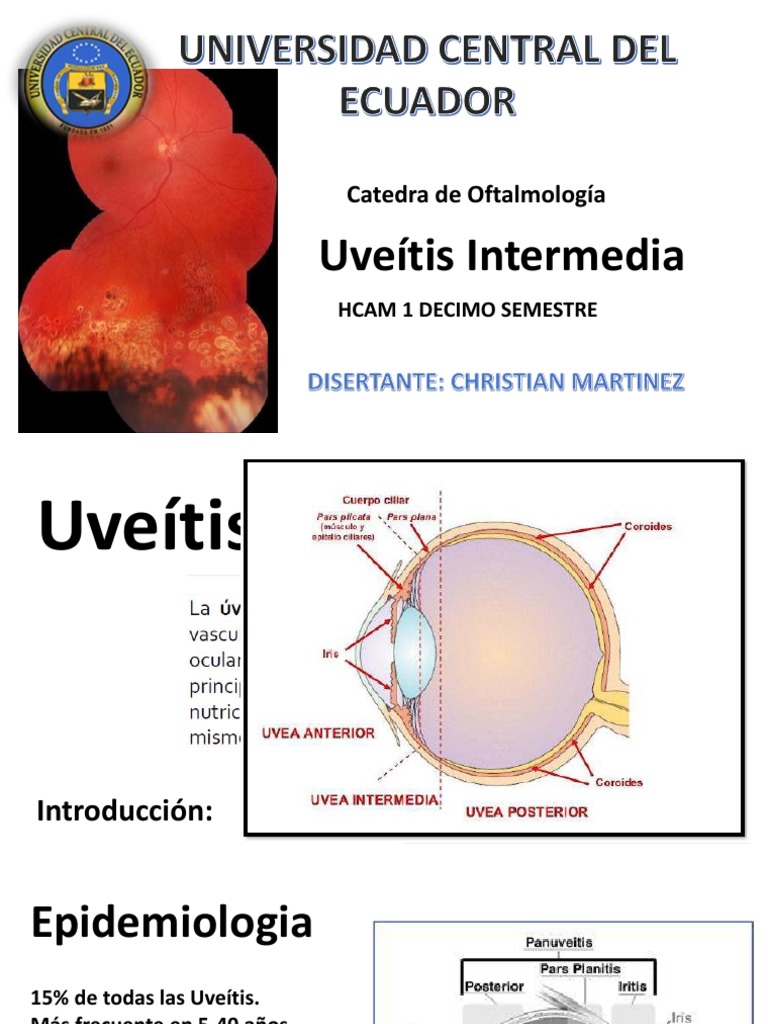 Expo Uveitis Intermedia | PDF | Corticosteroides | Glaucoma