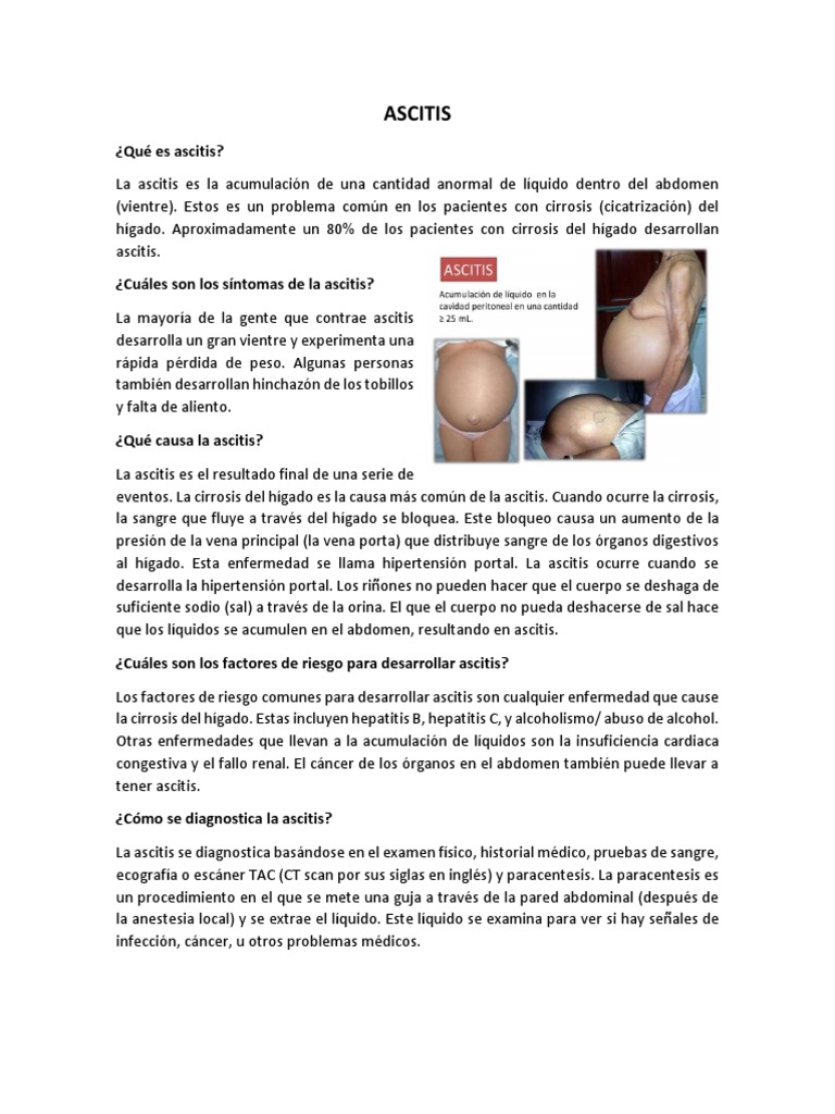 ASCITIS | PDF | Cirrosis | sal