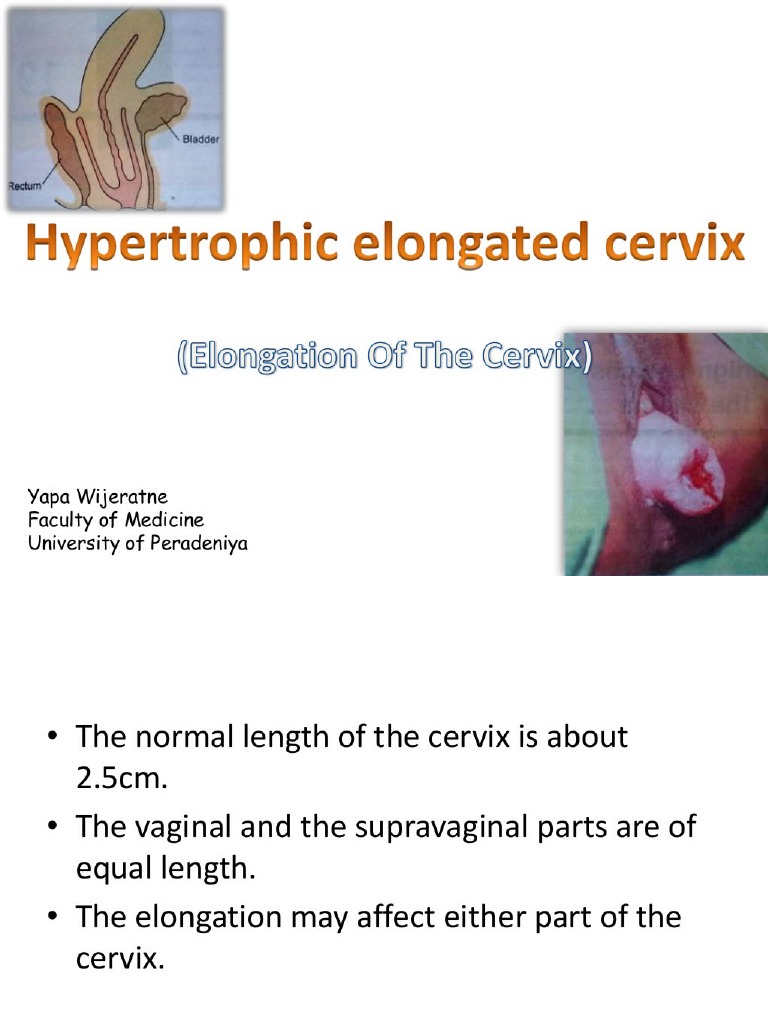 Hypertrophic Elongated Cervix (Elongation of Cervix) | PDF
