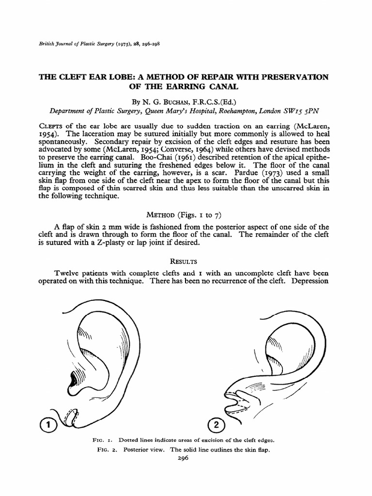 The Cleft Ear Lobe: A Method of Repair With Preservation of The Earring ...