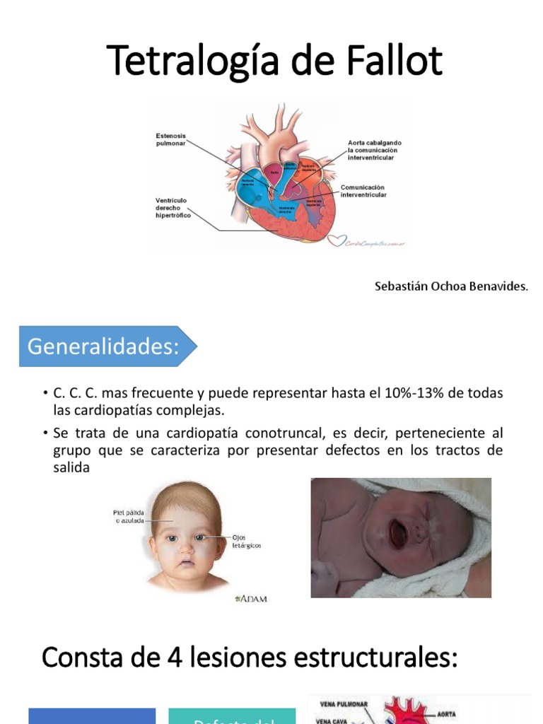 Manejo de la Tetralogía de Fallot | PDF | Defecto cardiaco congenito ...