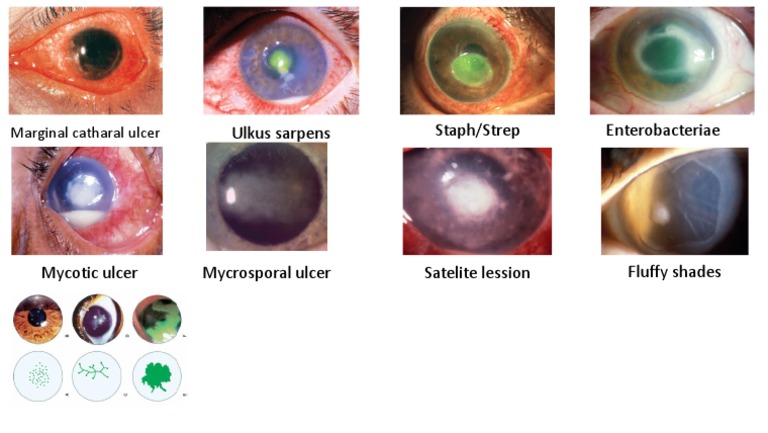 Ulkus Sarpens Staph/Strep Enterobacteriae: Marginal Catharal Ulcer | PDF