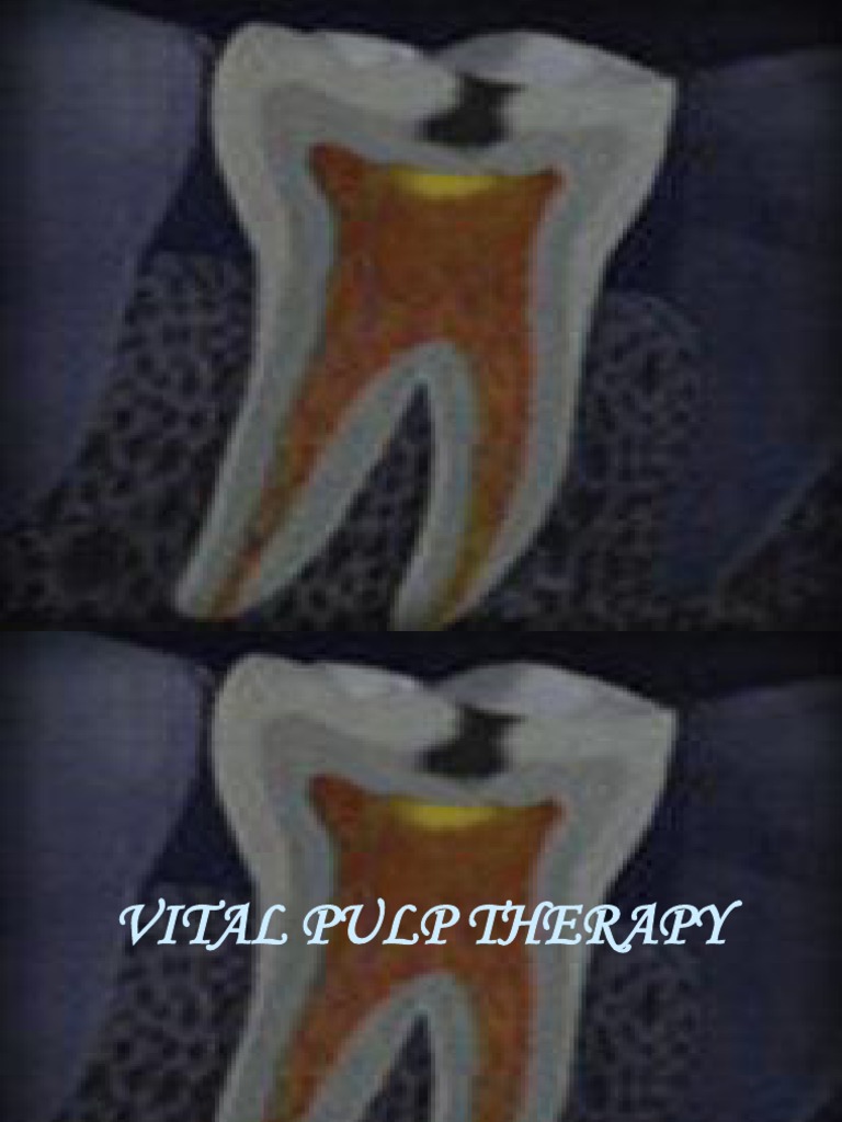 Vital Pulp Therapy Final | PDF | Dentin | Mouth