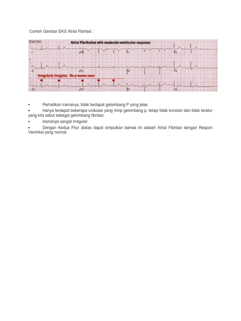 Contoh Gambar EKG Atrial Fibrilasi | PDF
