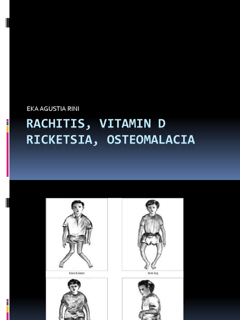 Rachitis, Vitamin D Ricketsia, Osteomalacia: Eka Agustia Rini | PDF ...