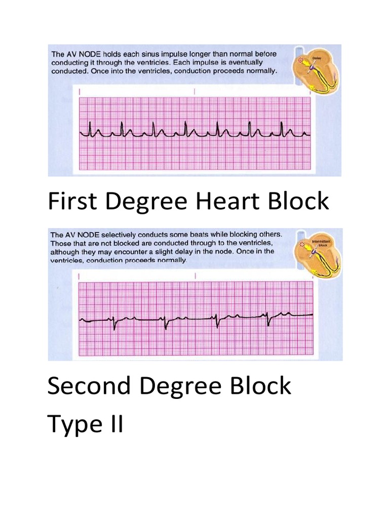 Understanding Heart Block Types | PDF