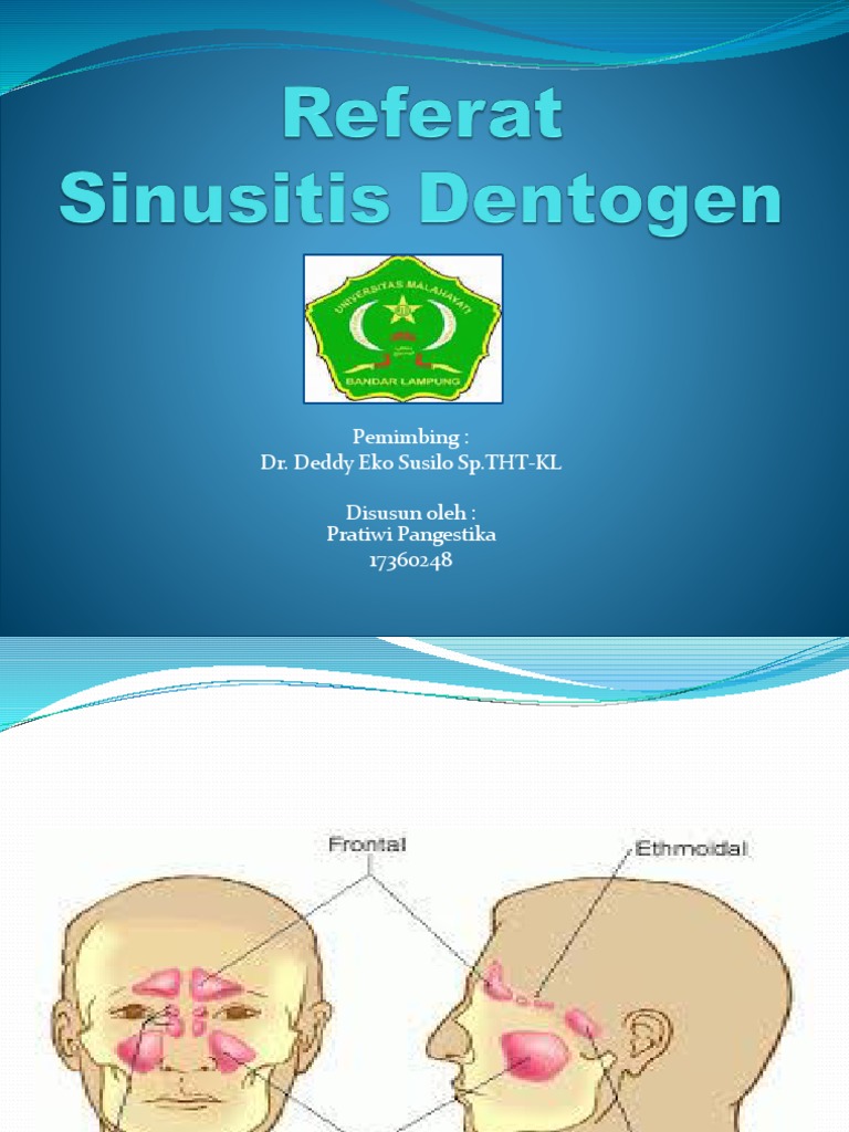 Sinusitis Dentogen | PDF