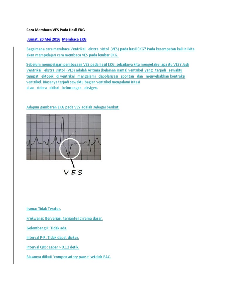 Membaca VES pada Hasil EKG | PDF