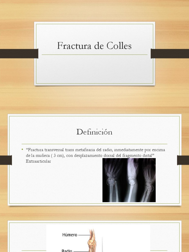 Fractura de Colles: Guía completa sobre su definición, clasificación y ...