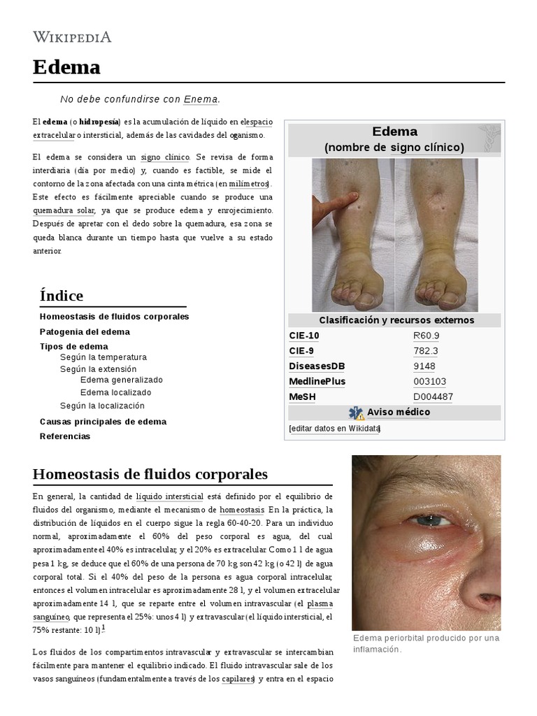 Edema | Edema | Sistema circulatorio