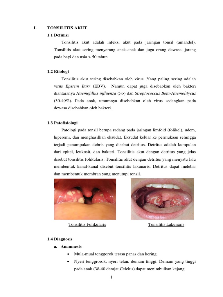 Tonsilitis Akut Dan Difteri | PDF