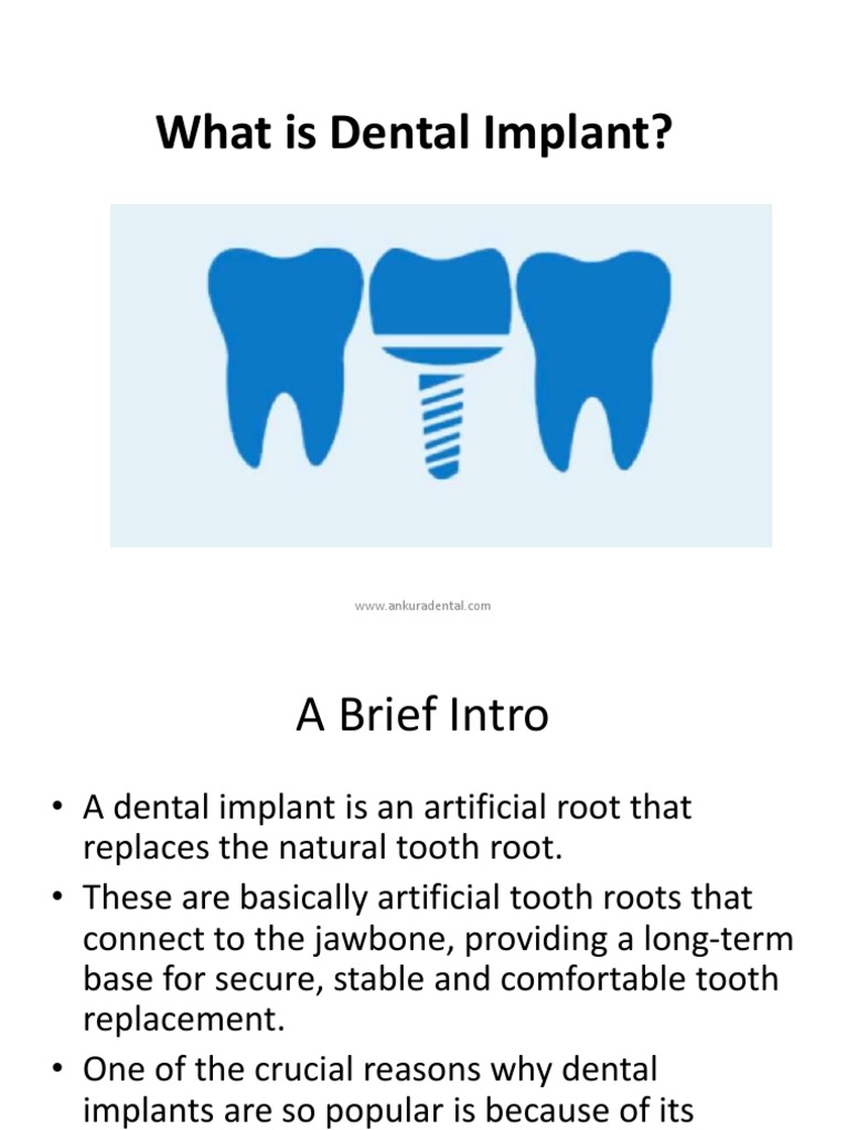 Dental Implants | PDF | Dental Implant | Health Care