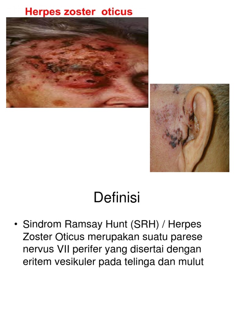 Herpes Zoster Oticus | PDF