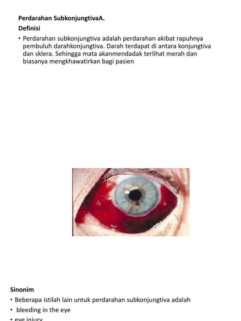 Perdarahan Subkonjungtiva | PDF